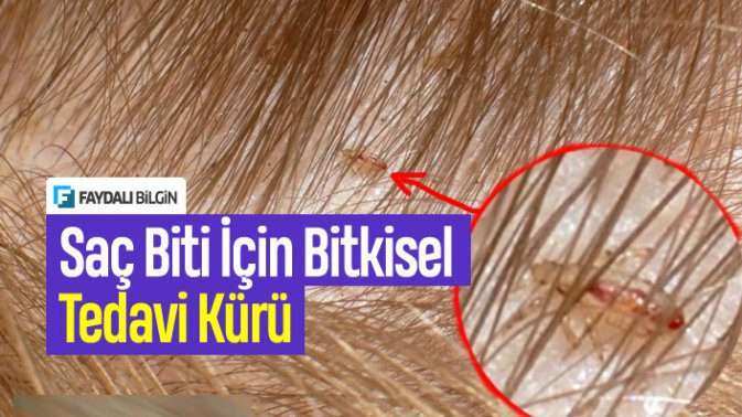 Saç Biti İçin Bitkisel Tedavi Kürü - Faydalı Bilgin